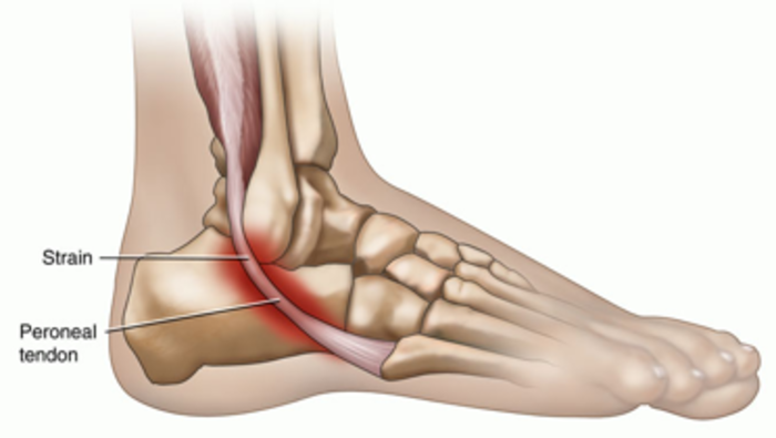 Common Foot Injuries You Don t Know But Should A Listly List common-foot-injuries-you-don-t-know-but-should-a-listly-list